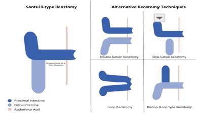 Illustrated Types ofIleostomies